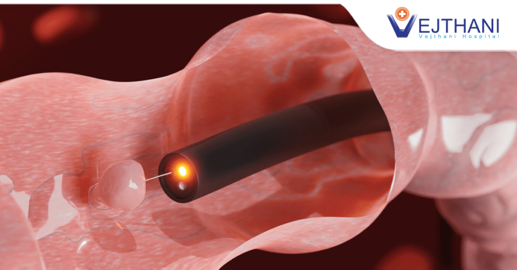 Blood in the Stool, a Sign of Colorectal Cancer - Life Cancer Center