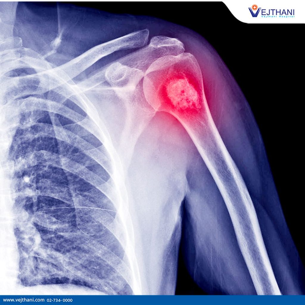Bone Cancer Life Cancer Center Bone Cancer Life Cancer Center