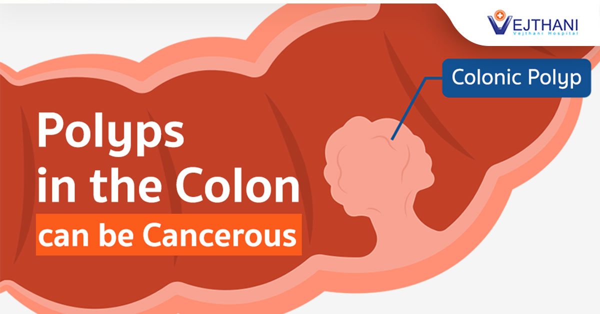 Polyps in the Colon can be Cancerous - Life Cancer Center