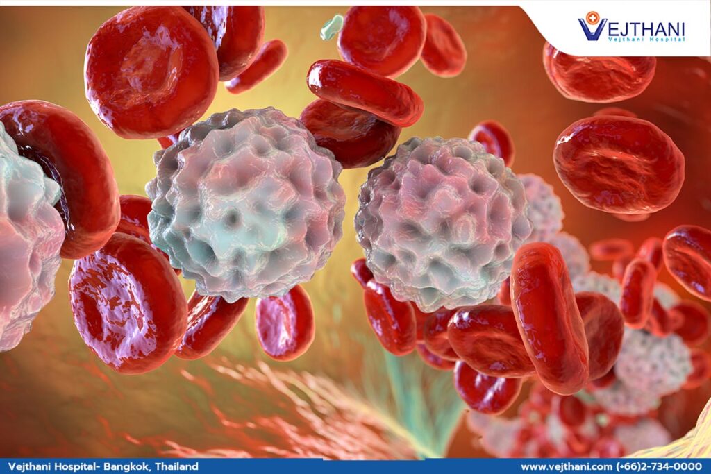 Acute Lymphoblastic Leukemia - Life Cancer Center