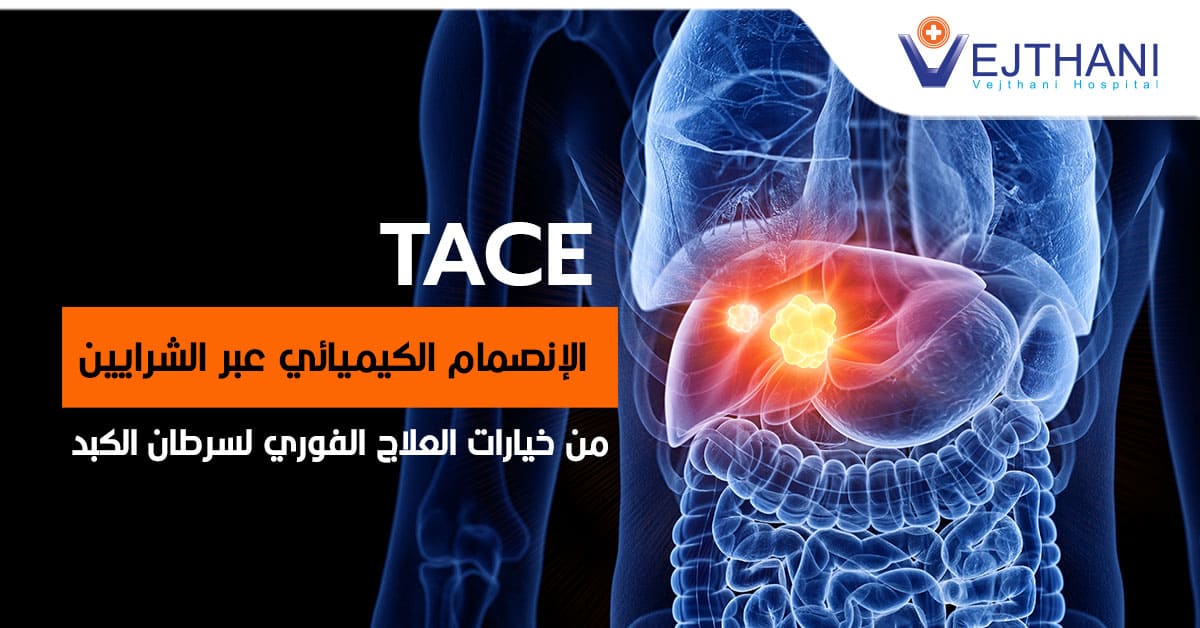 TACE الإنصمام الكیمیائي عبر الشرایین، من الخیارات علاج الفوري لسرطان ...